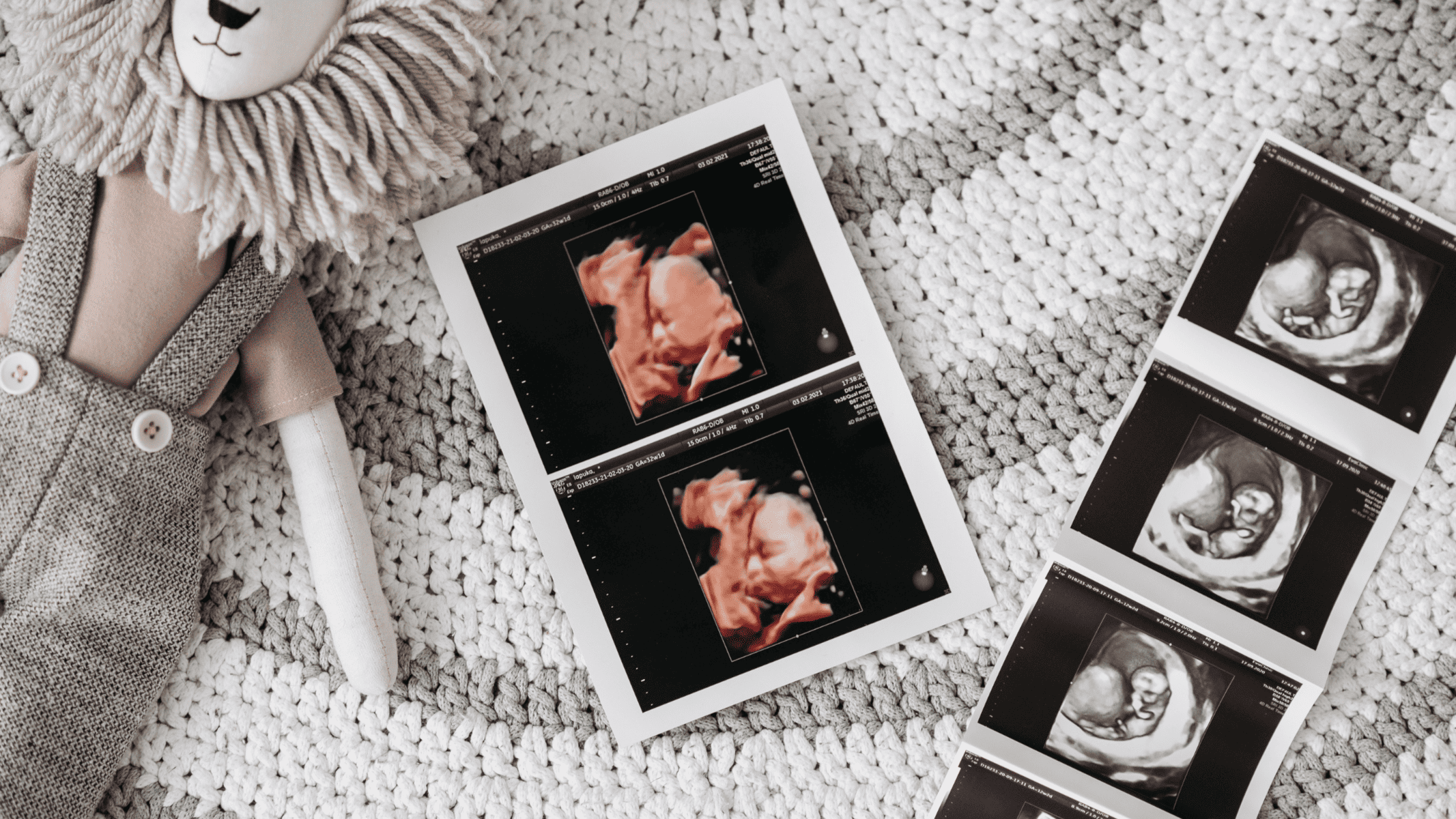 19 Weeks Pregnant Ultrasound Scan: What to Expect – Journey for Jasmine